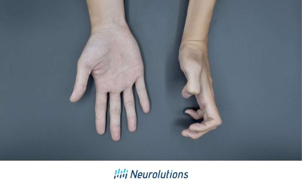 Understanding and Managing Muscle Atrophy after Stroke - Neurolutions